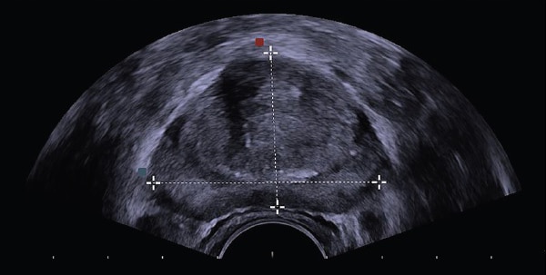 Przewlekłe zapalenie prostaty - leczenie ESWT - KORE nr 1