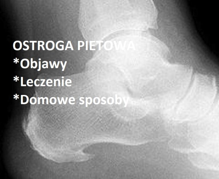 Ostroga piętowa - leczenie w 3-6 tyg. Metody - [PORADNIK]